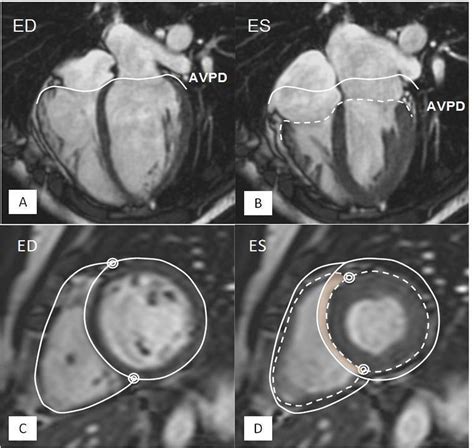 Regional Contributions To Ventricular Stroke Volumes Are Affected On