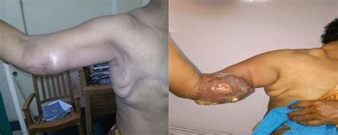 Metastatic Epitrochlear Lymph Node Progressive Disease Epitrochlear Download Scientific