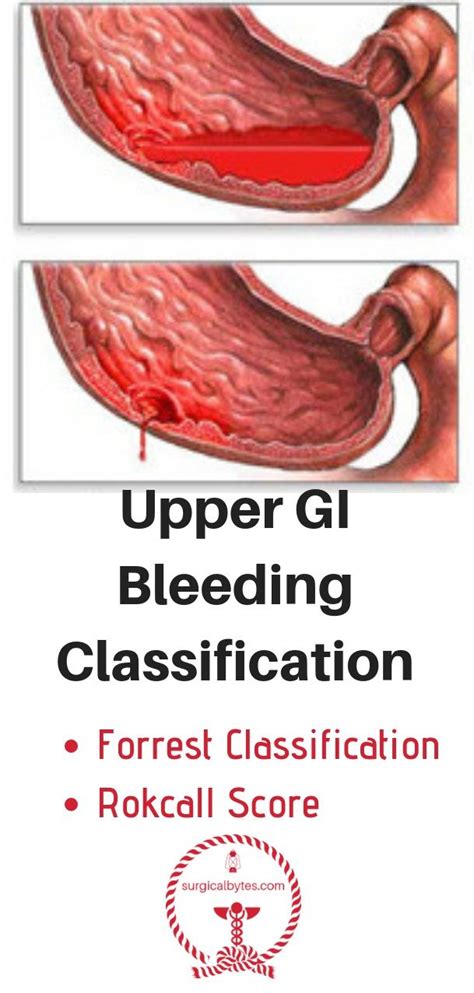 Gastrointestinal Bleeding Deadly At Robyn Hamby Blog