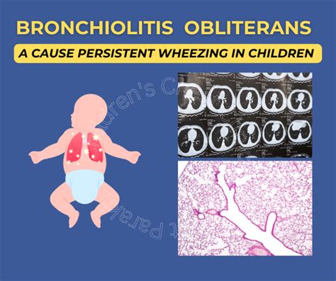 Bronchiolitis Obliterans Dr Ankit Parakh Indias Best Pediatric