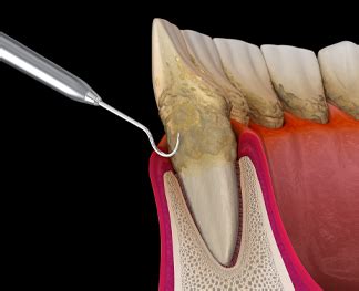 Scaling And Root Planing Timberlane Dental Group South Burlington Essex Junction Burlington