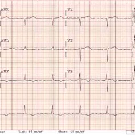 Schematic Anatomy Of The Av Node View From The Right Atrium Ivc