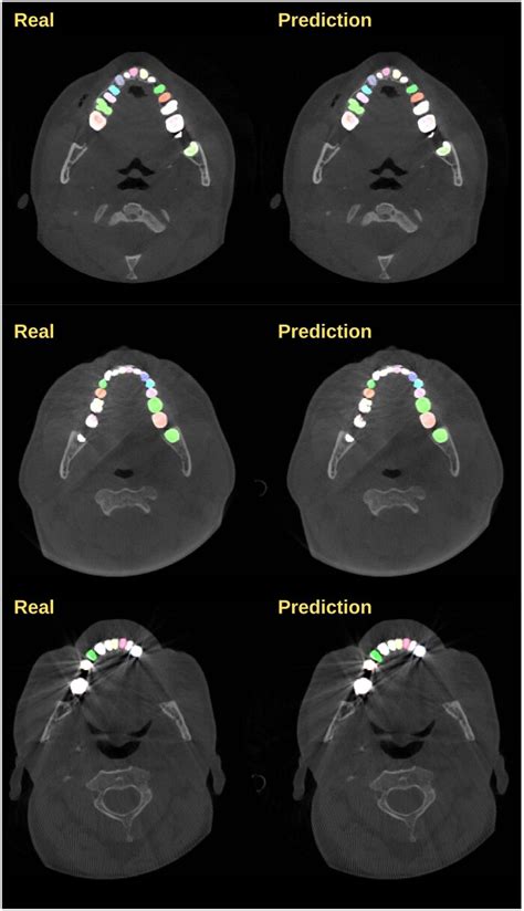 Advancing Periodontal Diagnosis Harnessing Advanced Artificial