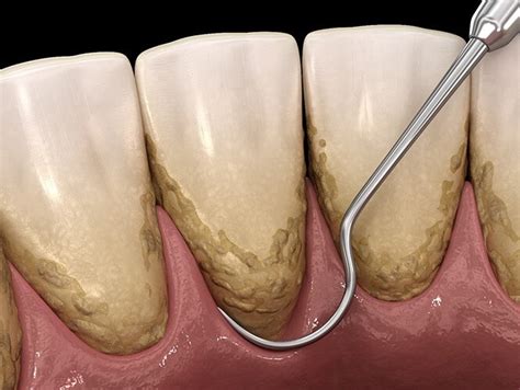 Scaling Root Planing Periodontics And Implant Dentistry Of Tallahassee