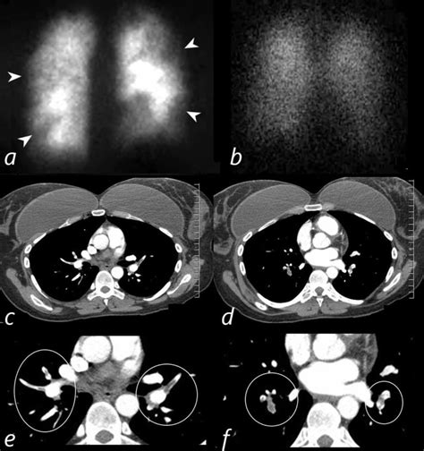 Ventilation Perfusion Scan V Q Scan Lungs