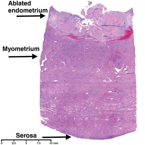 Endometrial Ablation Normal Imaging Appearance And Delayed