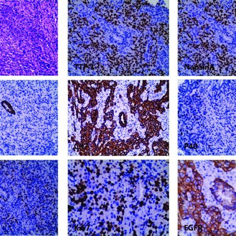 Lung Biopsy Specimen Hematoxylin Eosin Staining Shows Poorly