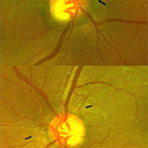 Optos Fundus Photos Of Patients Optic Nerve Of The Right Eye And Left