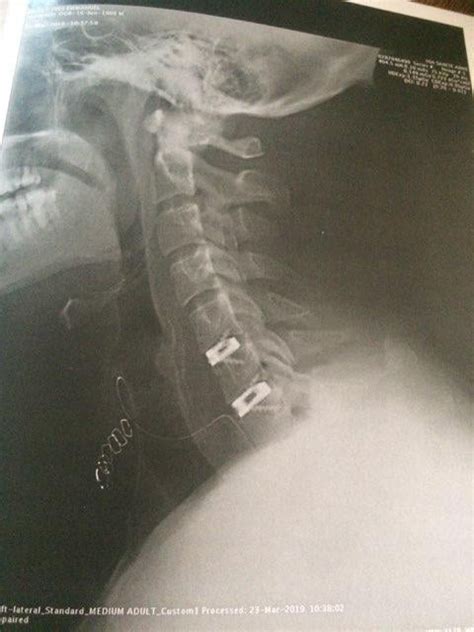 Just Back From C5 C6 C7 Fusion Surgery Anyones Experience R