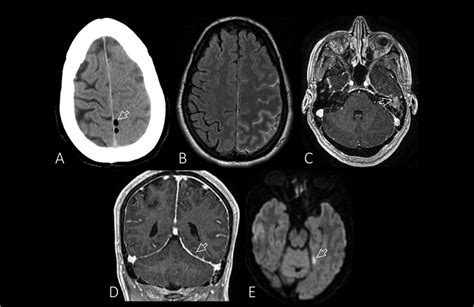 Otomastoiditis Meningitis And Subdural Empyema Axial Non Contrast Ct