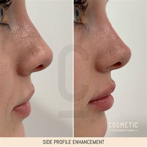 Side Profile Enhancement Pretty Nose Nose Shapes Perfect Nose