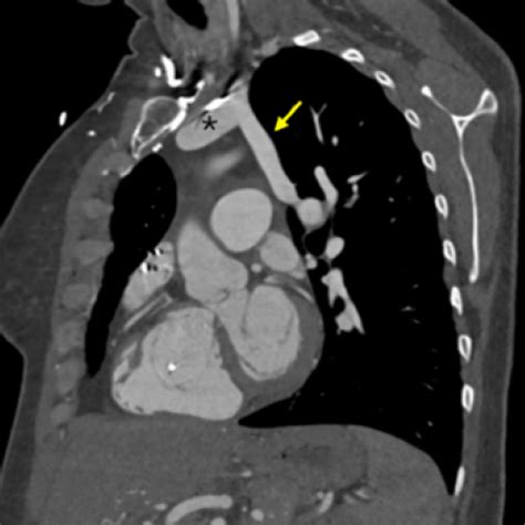 Ct Imaging Diagnosis Of Partial Anomalous Pulmonary Venous Drainage Eurorad