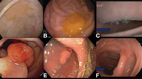 Natural Or Biologic Chromoendoscopy For Detection Of Colorectal Polyps