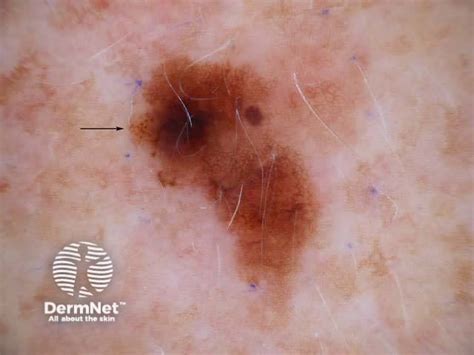 Dermoscopy Malignant Melanoma