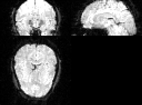 Inter Slice Motion Correction For Fmri Namic Wiki