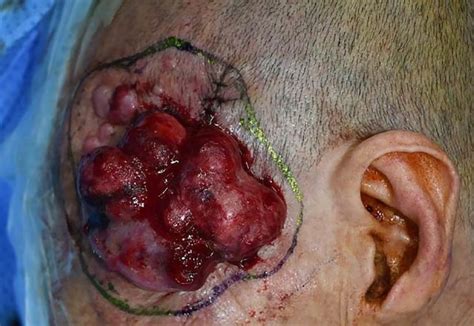 An Aggressive Cutaneous Sarcomatoid Squamous Cell Carcinoma Of The Face