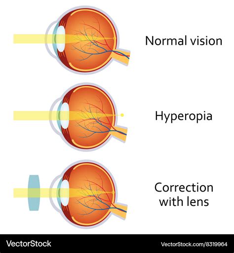Hyperopia Lens