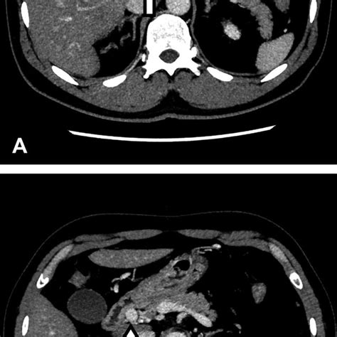 Contrast Enhanced Computed Tomography Showing An Enlarged Caudate Lobe Download Scientific