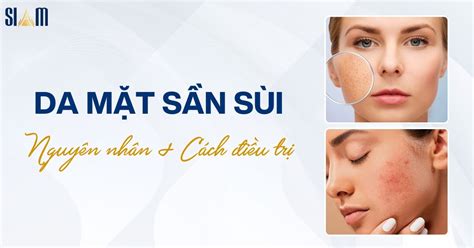 Da Mặt Sần Sùi Nguyên Nhân Và Cách điều Trị Hiệu Quả