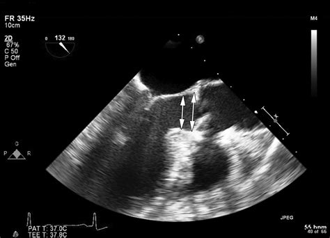 Aortic Annulus Measurement