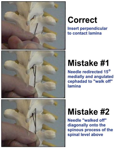 Walking Epidural Anesthesia At Sara Swasey Blog