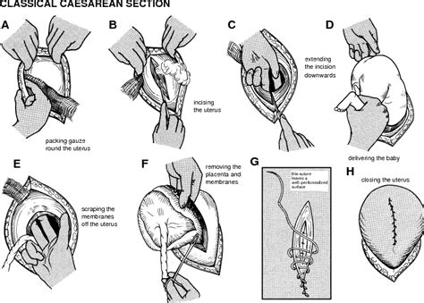 Most Common Incision For Cesarean Section At Amber Byers Blog