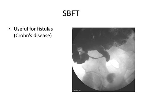 Ppt Imaging Of The Small Bowel Powerpoint Presentation Free Download