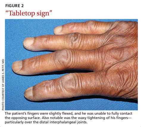 Diabetic Cheiroarthropathy