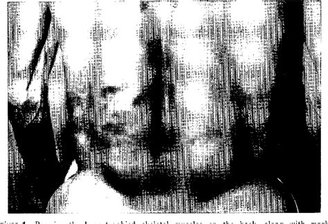 Figure 2 From AL Amyloidosis Semantic Scholar