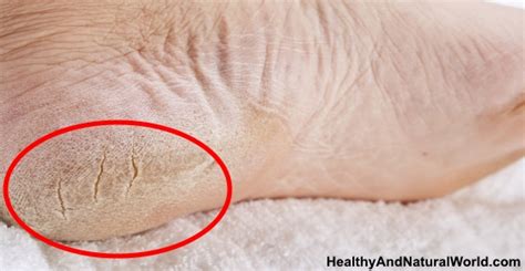 How To Get Rid Of Dead Dry Skin On Feet Life Magnet