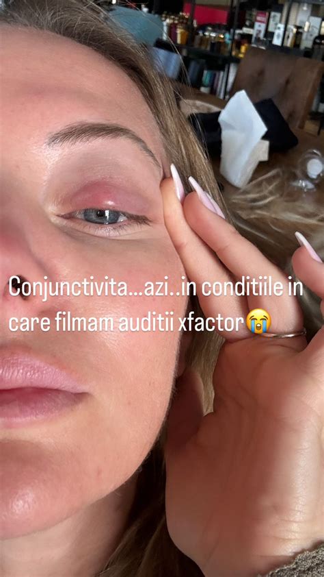 Delia Cu Ochiul Umflat La Masa Juriului A încercat Să Mascheze Cu