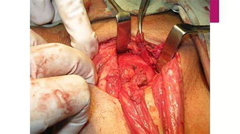 Hernia Operation Pptx