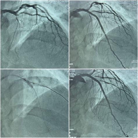 Pankaj Jariwala On Linkedin Primary Angioplasty Of The Lad Acute