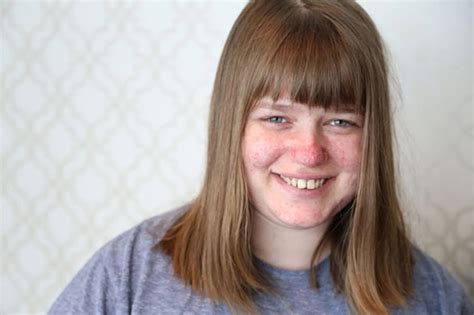 50 Facts About Tuberous Sclerosis