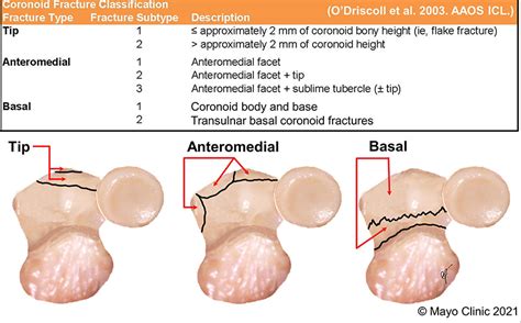 Elbow Instability Elbow And Shoulder Laboratory Mayo Clinic Research