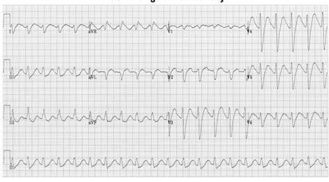TCA Overdose Critcareedu