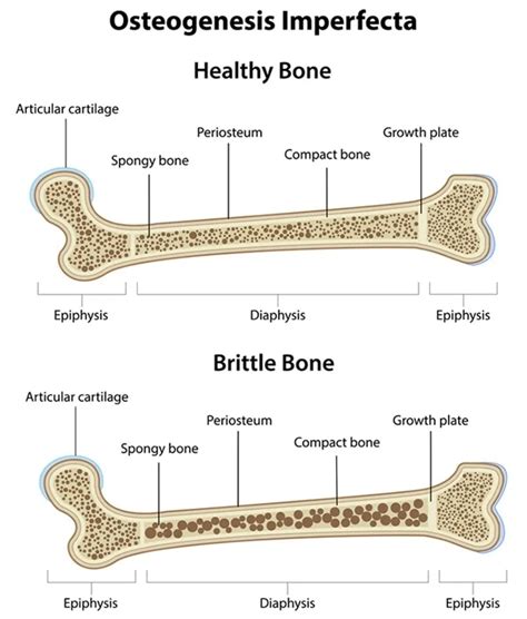 Osteogenesis Imperfecta Nurses Revision
