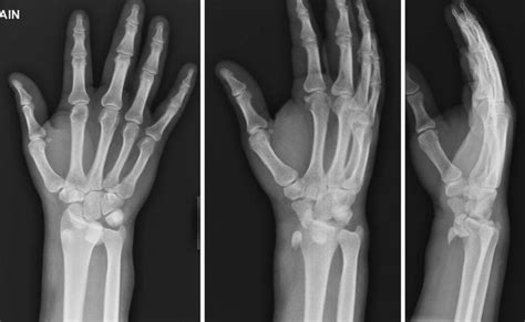 Volar Dislocation Of The Lunate With 270° Rotation