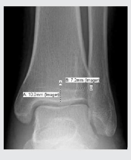 Radiographic Measurement Of Tibiofibular Clear Space Download Scientific Diagram