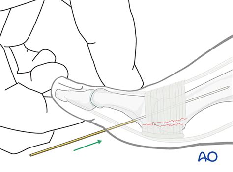 Crif K Wire Fixation For Mtp Joint Dislocation