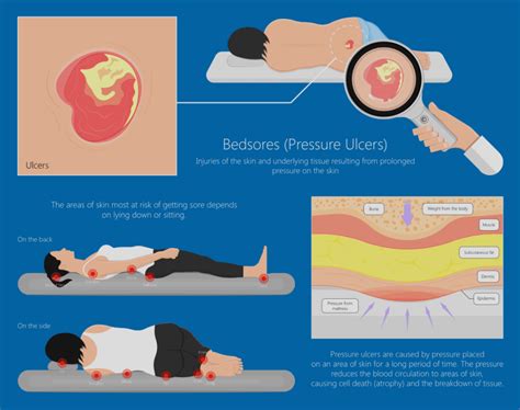 What Causes Bedsores Bedsore Law