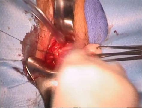 Total Vaginal Hysterectomy By Steven Mccarus Md Jandj Medtech