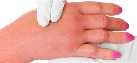 Edema Symptoms Causes And Other Associated Risk Factors