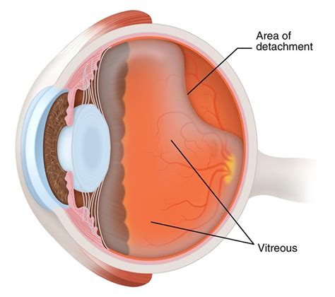 Posterior Vitreous Detachment Griffin Takle Eye Group