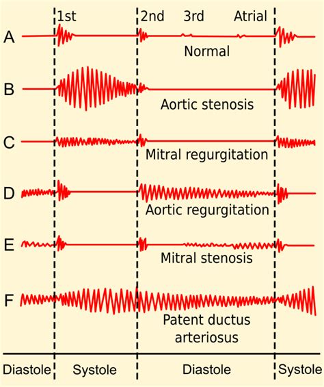 Heart Murmur Wikipedia