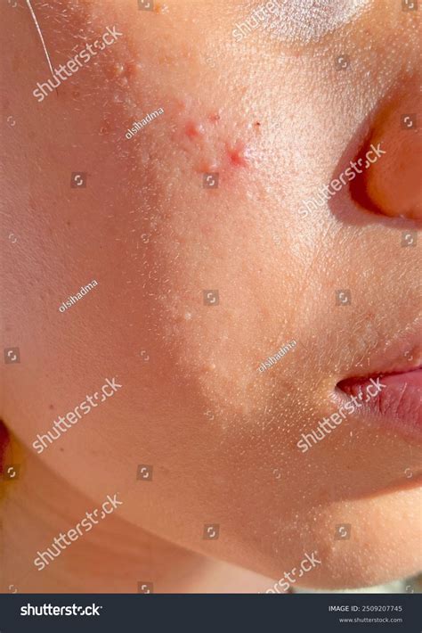 Asian Woman Skin Problem Acne Whitehead Nh C S N Shutterstock