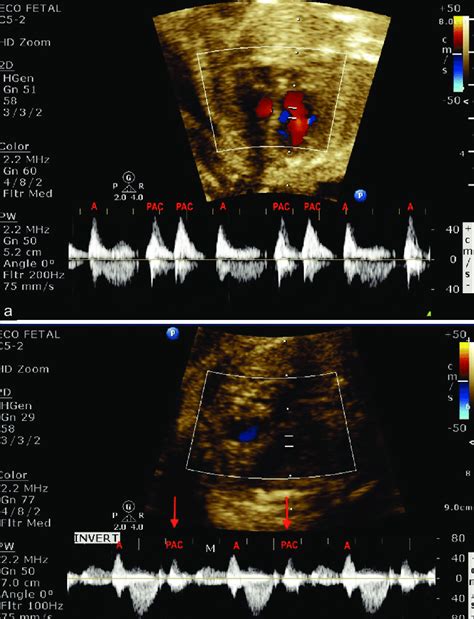 Blocked Atrial Bigeminy Frequently Has A Variable Atrial Rhythm With A Download Scientific