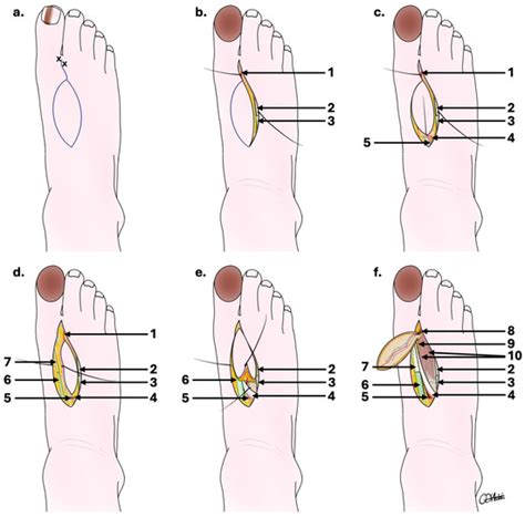 Dorsalis Pedis Flap