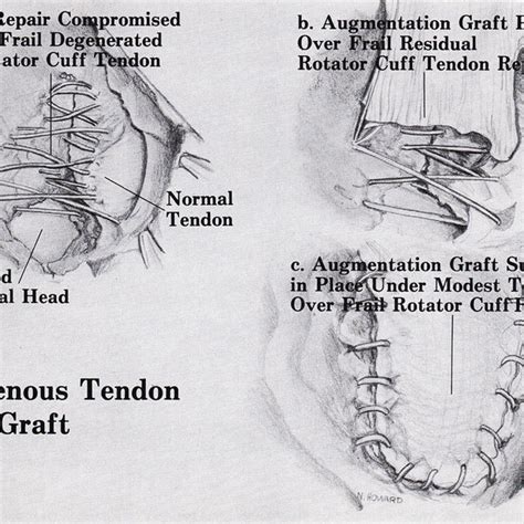 Intraoperative Representation Of Patch Graft Tissue Intraoperative