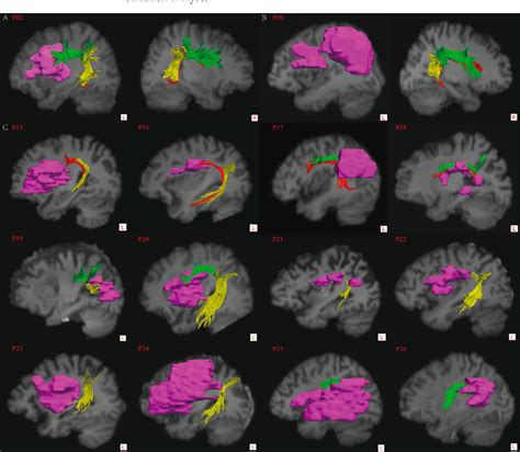 Figure 2 From Integrity Of The Left Arcuate Fasciculus Segments Significantly Affects Language